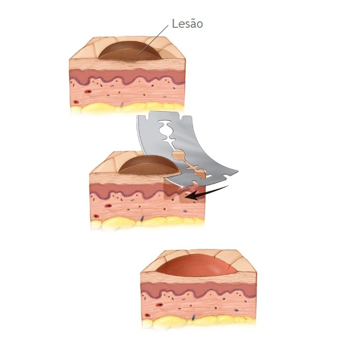 Biópsia da Pele - Dermatologista Dra. Letícia Valiati